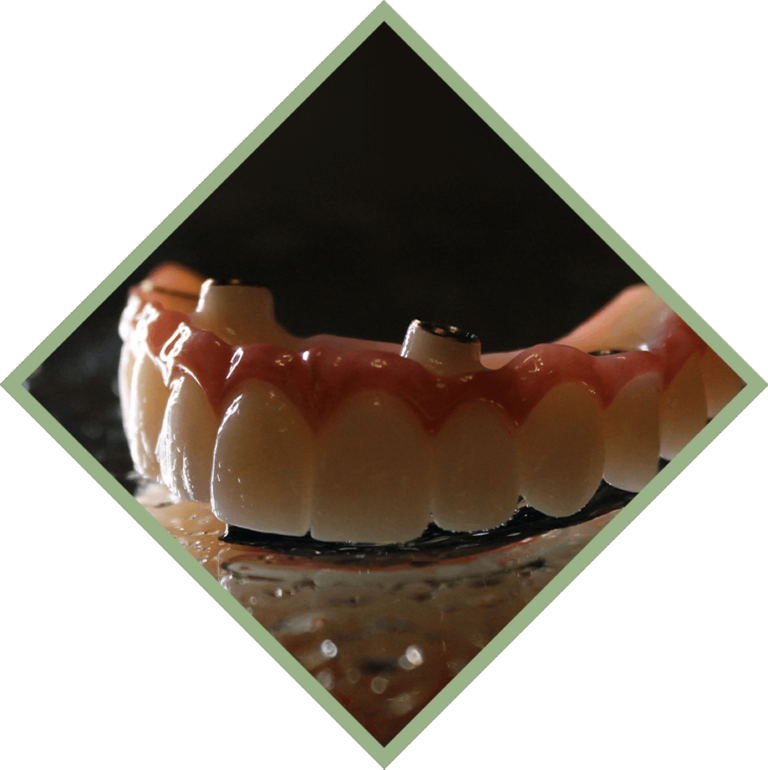 Zirconia Fixed Bridge | Hagerstown, MD | Smile Design Centre